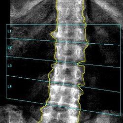 Bone Densitometry » Roosevelt, UT - Uintah Basin Medical Center ...